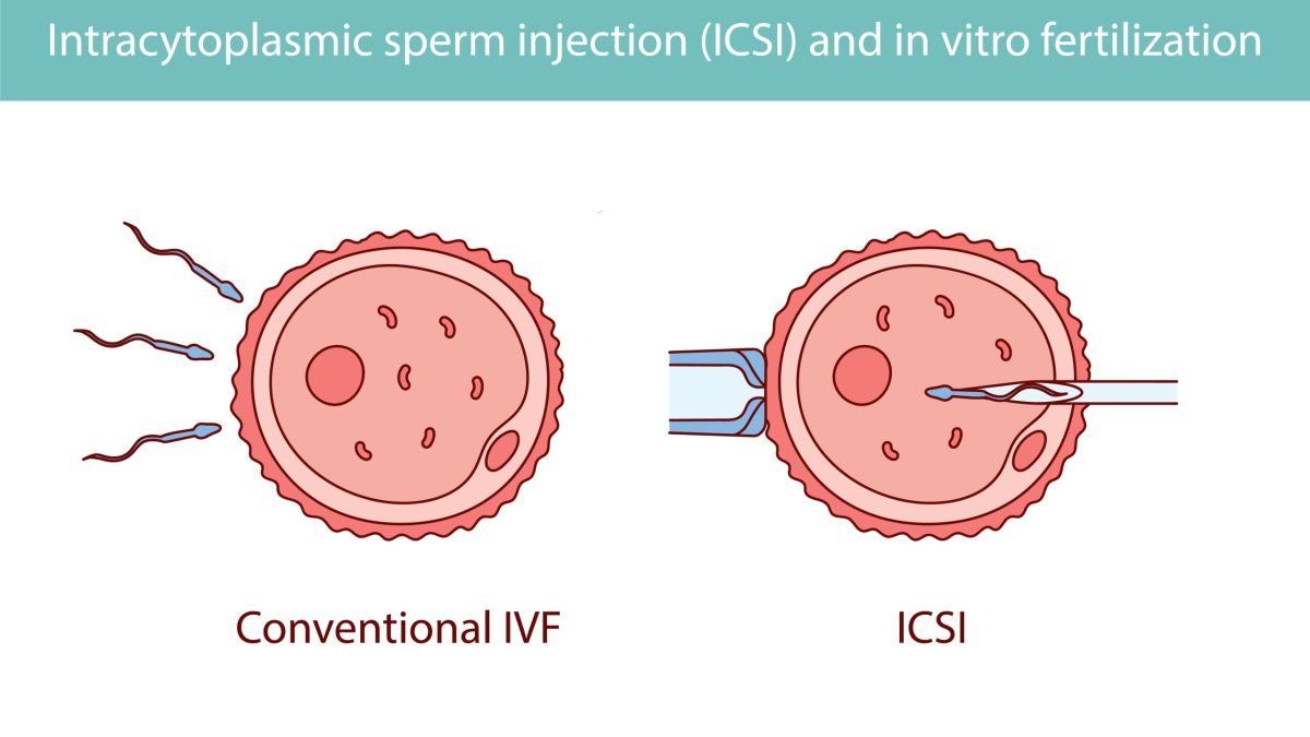 In Vitro Fertilization Diagram