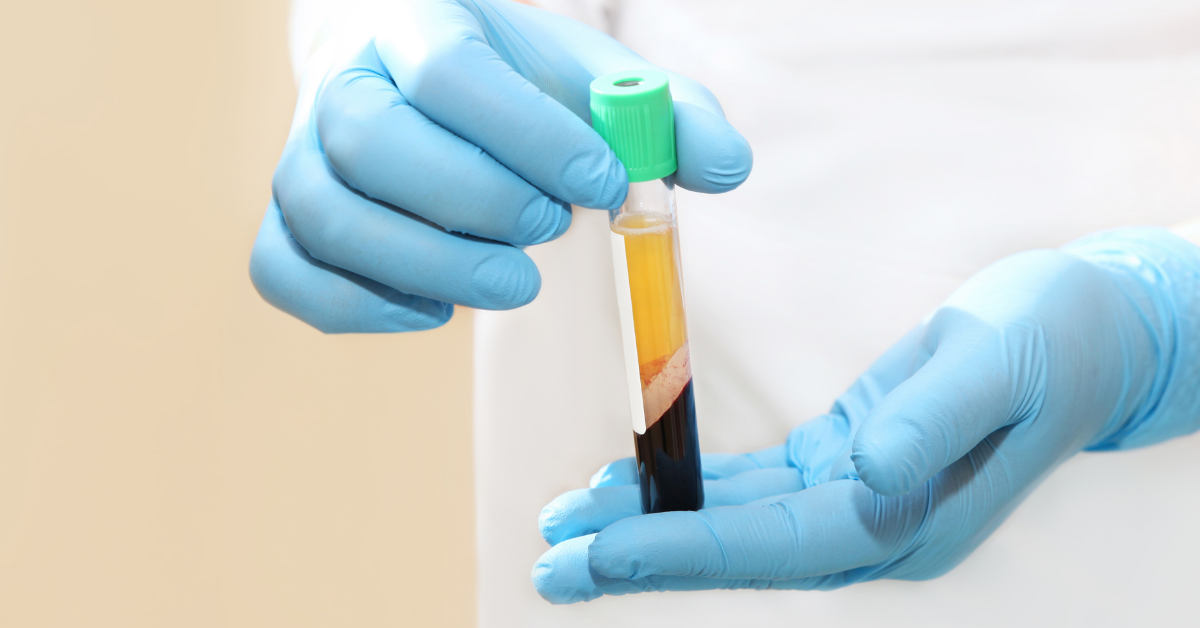 PRP for IVF & Infertility: A Treatment For Recurrent Implantation Failure